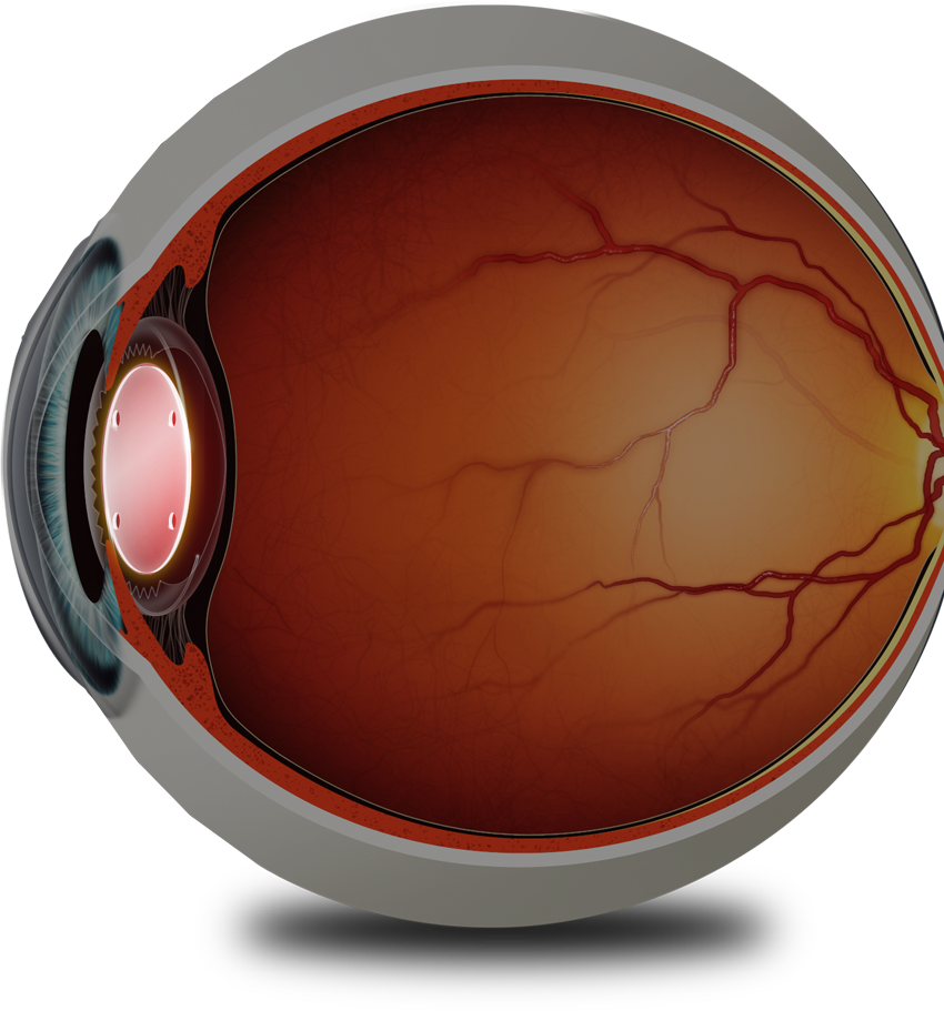 What Are The Leading Risk Factors For Retinal Detachment Retina