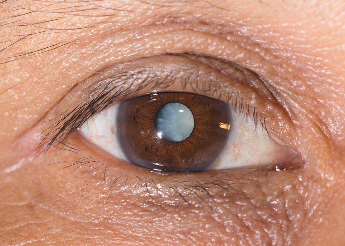 What Is Cystoid Macular Edema Retina Associates Kansas City